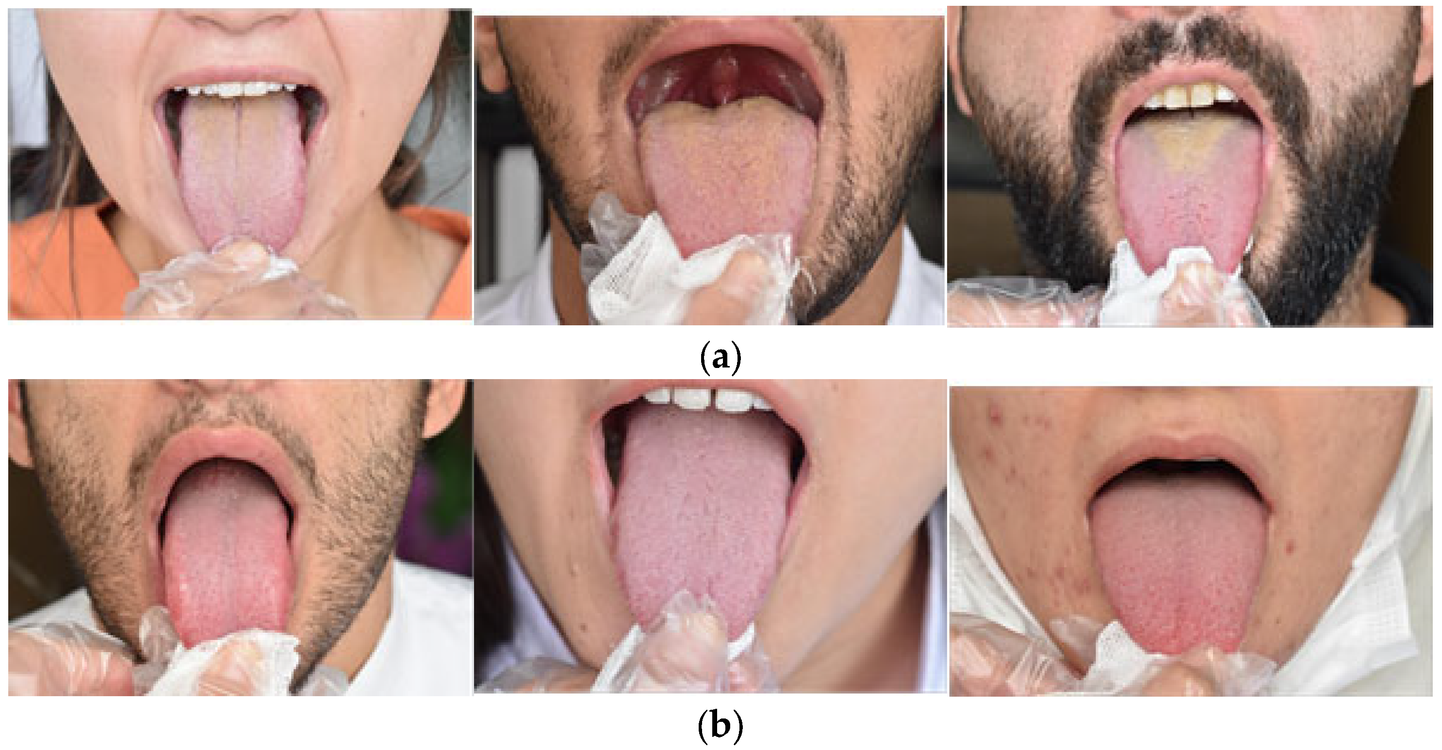 Artificial Intelligence in Oral Diagnosis: Detecting Coated Tongue with Convolutional Neural ...