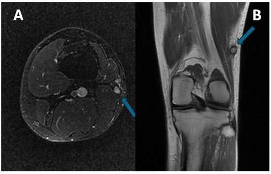 Clear Cell Sarcoma of Soft Tissues: Radiological Analysis of 14 ...
