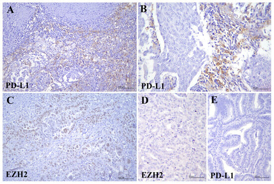 Immunoexpressions of PD-L1 and EZH2 in Endometrial Carcinoma: Associations with ...