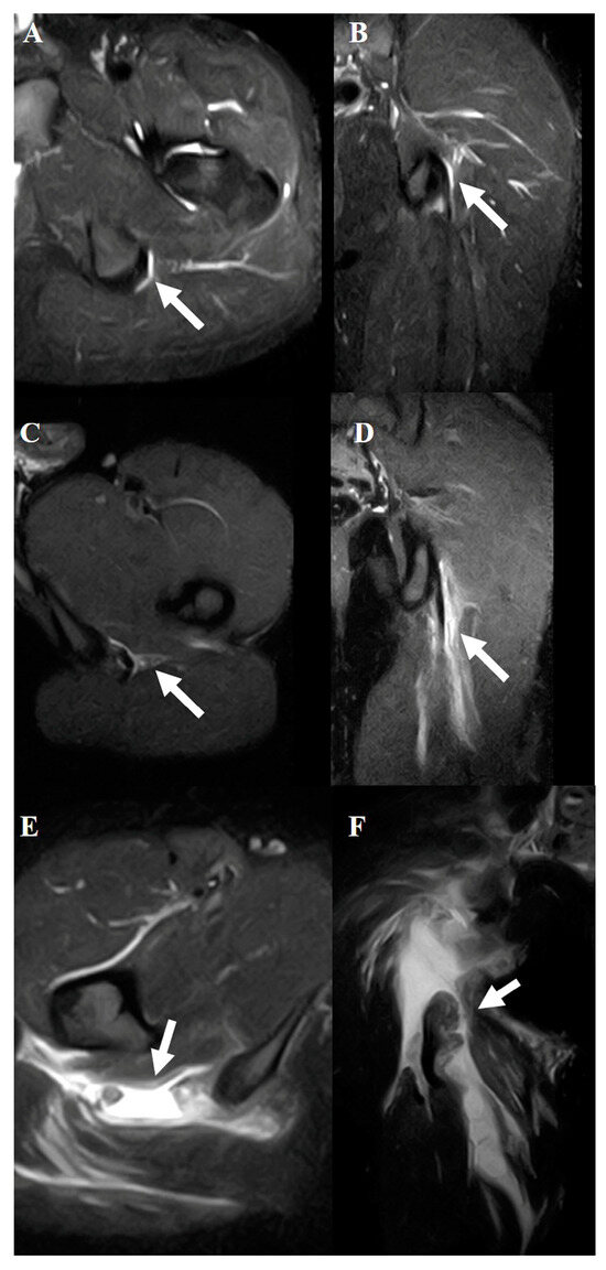 Role of Ultrasonography and MRI in Acute Hamstring Strains: Diagnostic ...
