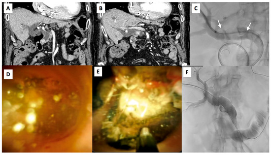 Efficacy and Safety of Percutaneous Transhepatic Lithotripsy Using ...