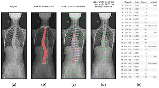 Convolutional Neural Network-Based Approach for Cobb Angle Measurement Using Mask R-CNN