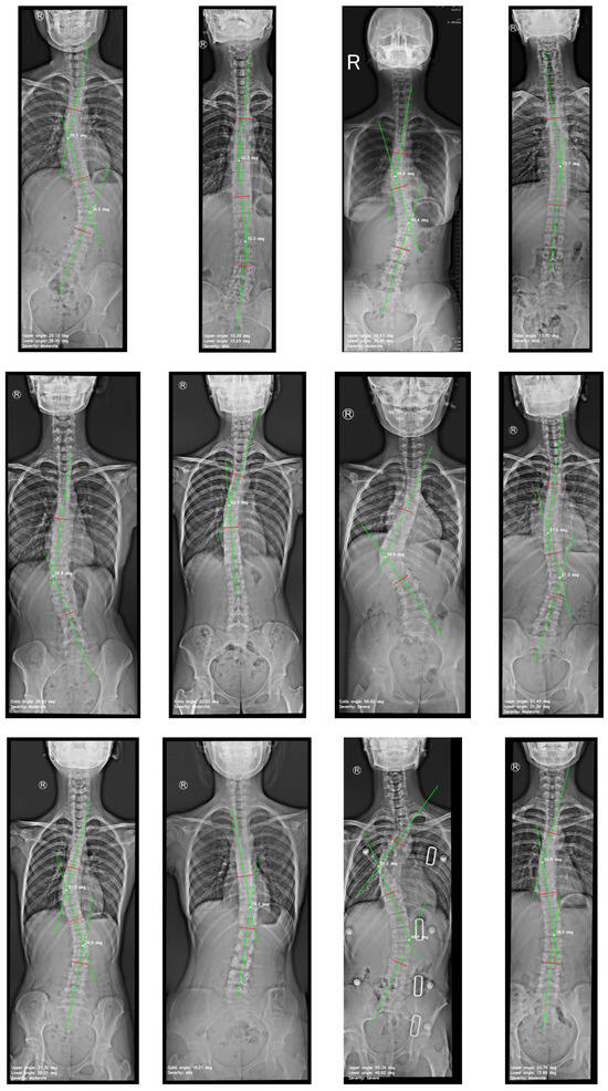 Convolutional Neural Network-Based Approach for Cobb Angle Measurement Using Mask R-CNN