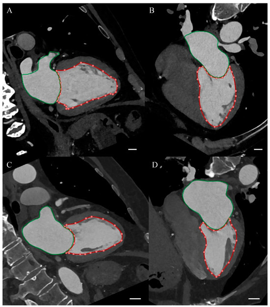 Association Between Cardiovascular Risk Assessed by the SCORE System ...