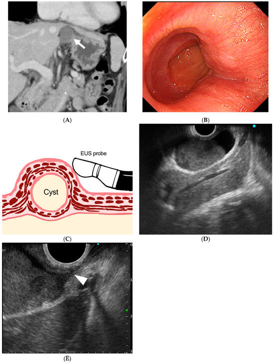 Preoperative Diagnosis of an Esophageal Duplication Cyst by Endoscopic ...