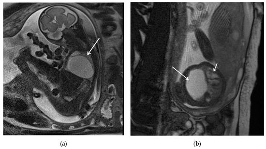 Pediatric Congenital Lung Malformation: Advanced Imaging Techniques in ...