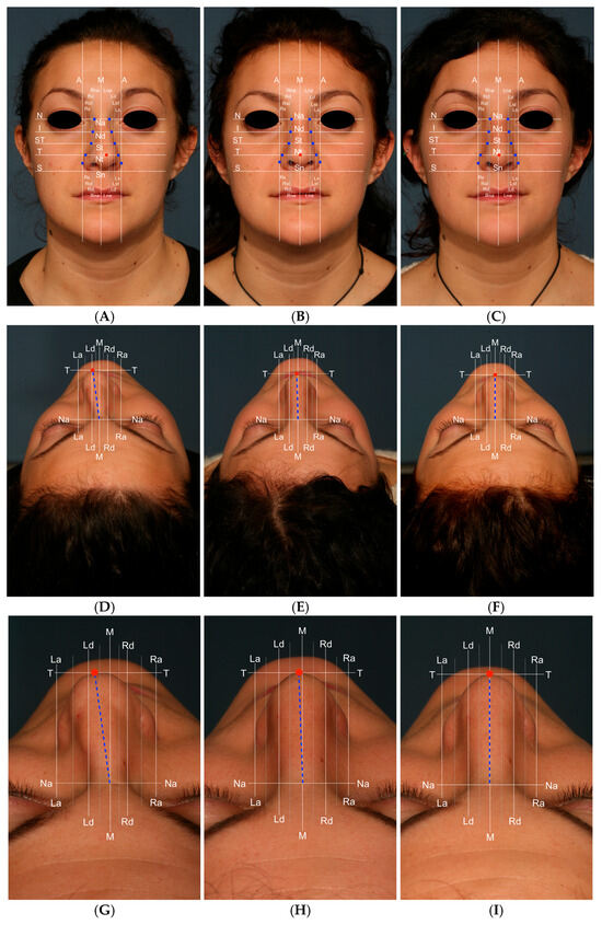 Long-Term Outcomes of Crooked Nose Correction: The Value of ...