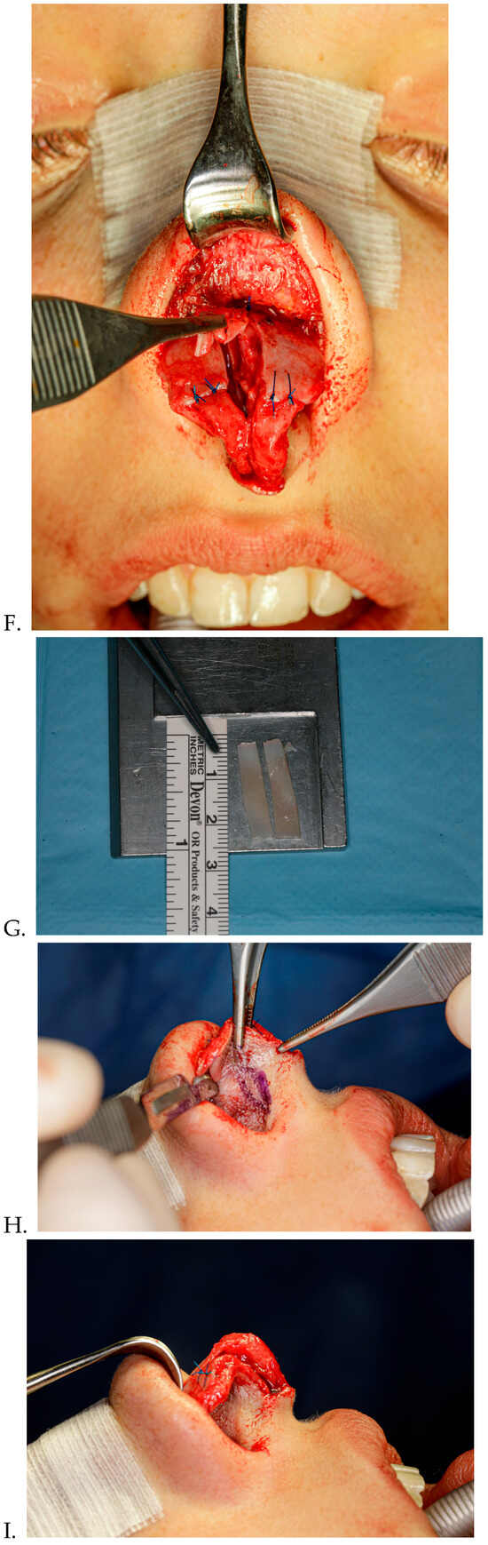 Long-Term Outcomes of Crooked Nose Correction: The Value of ...