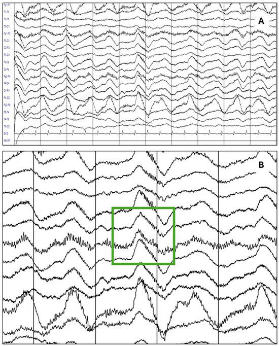 The Clinical Significance of Abnormal Electroencephalography (EEG ...