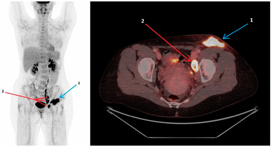 18F-FDG PET/CT Findings in Glandular Tularemia