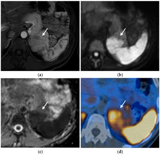 Multimodal Imaging Approach to MEN-1 Syndrome-Associated Tumors