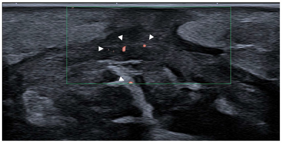 Ultrasonography of the Fasciae and Common Pathologies: The Game Changer