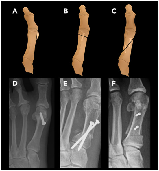 Osteotomies: Indications, Imaging Appearance, Surgical Techniques, and ...