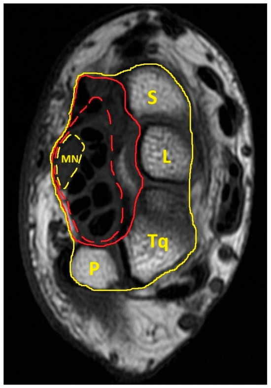 Comparing the Carpal Tunnel Area and Carpal Boundaries in Patients with ...