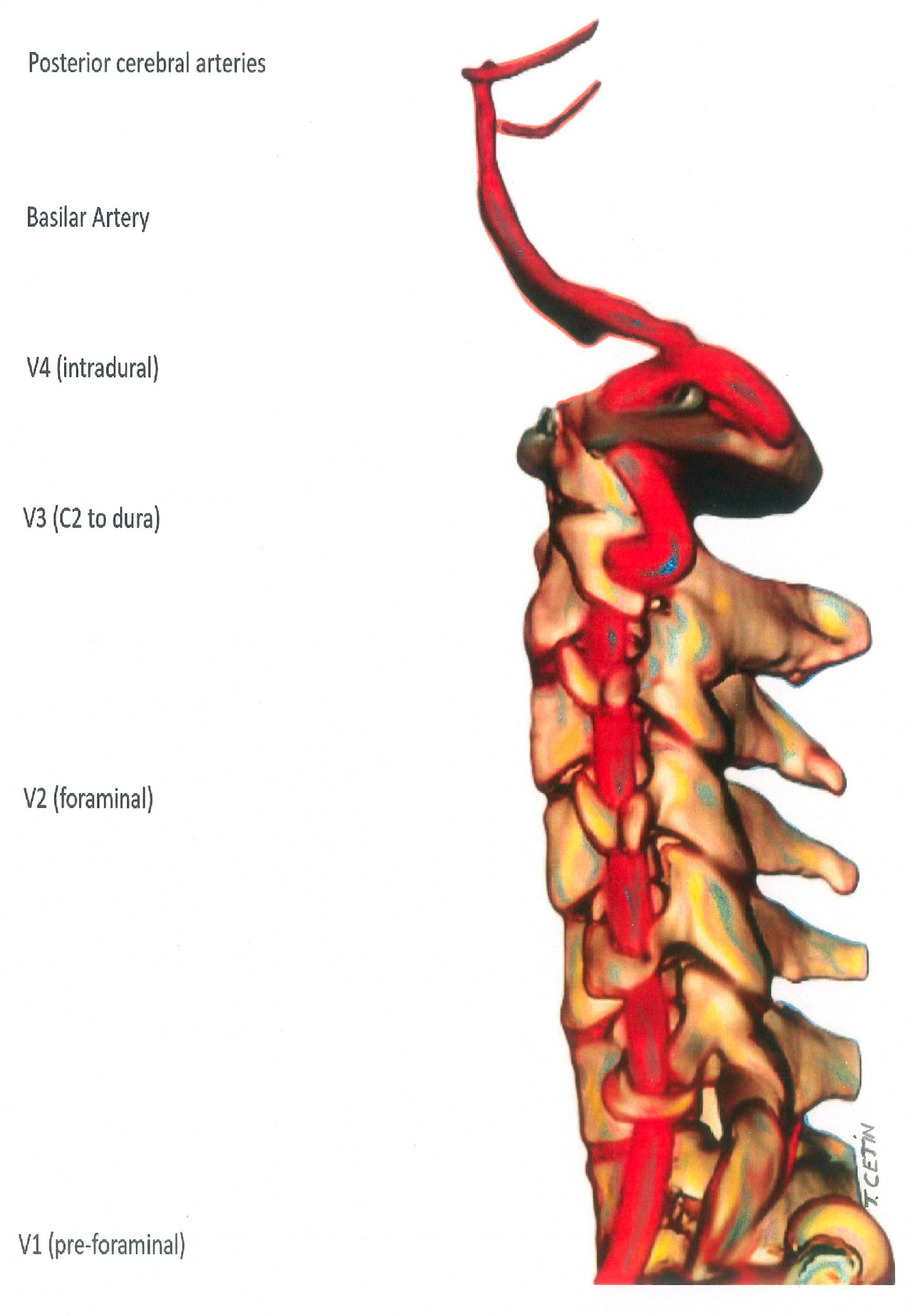 Incidental Calcifications of Carotid and Vertebral Arteries: Frequency ...