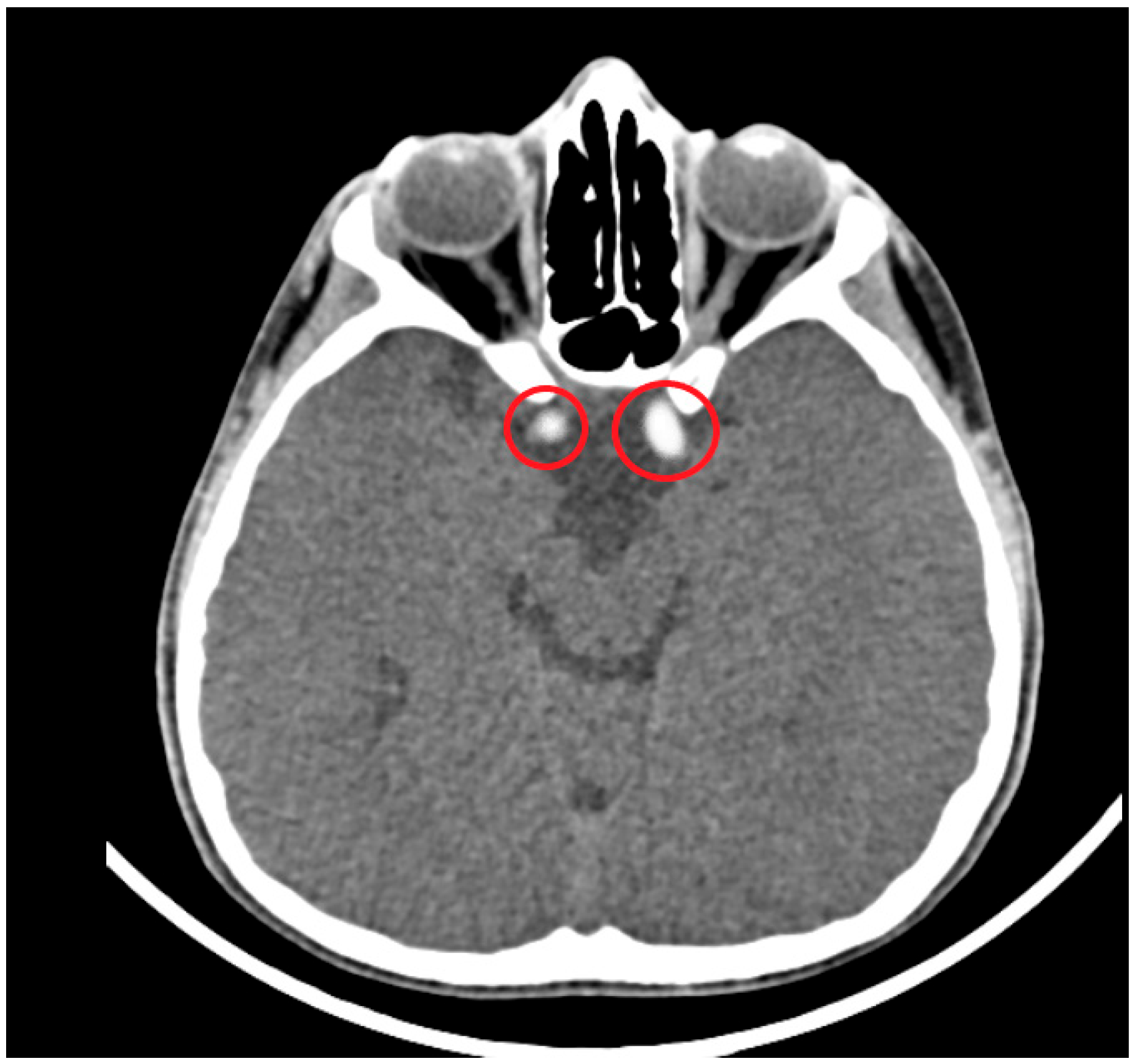 Incidental Calcifications of Carotid and Vertebral Arteries: Frequency ...