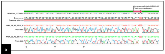 The Clinical and Laboratory Profiles of a Deletional α2-Globin Gene ...