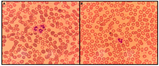 Platelet Satellitism in a Patient with Underlying Infection, Immune ...