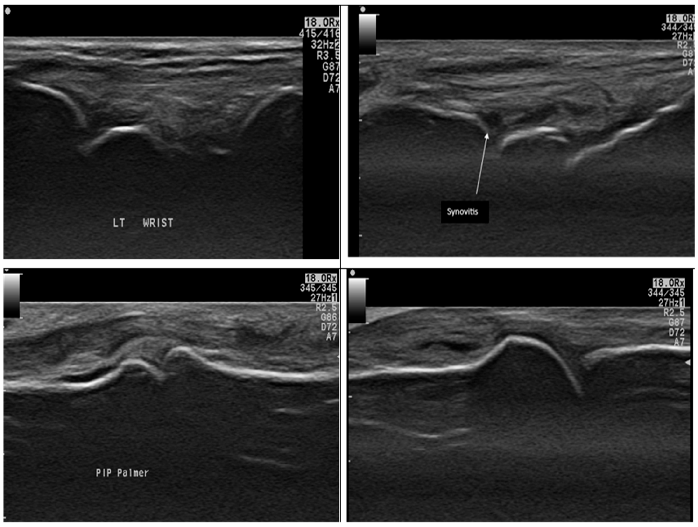 Serum Interleukin-17 and Its Association with Inflammation and Bone ...
