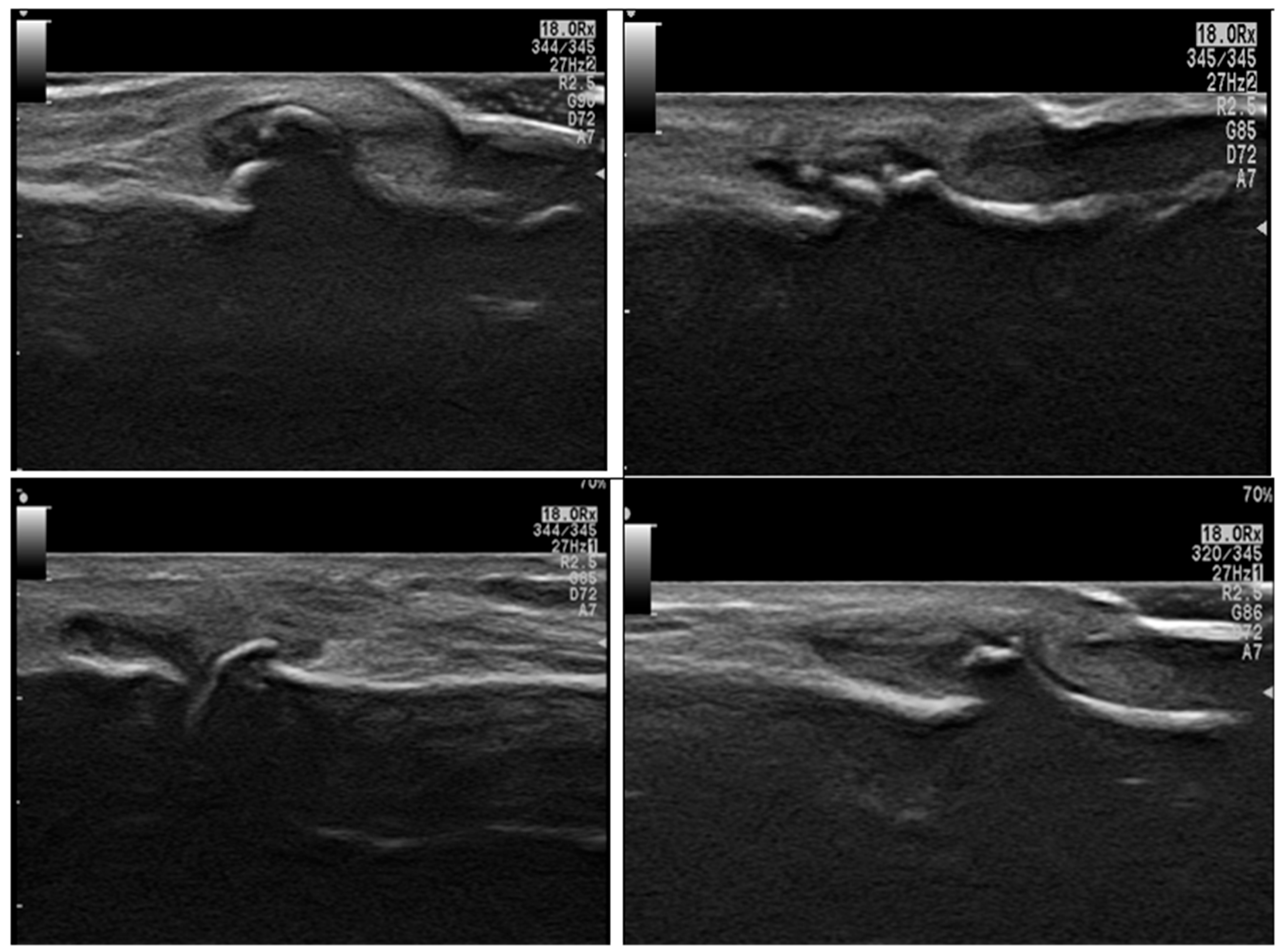 Serum Interleukin-17 and Its Association with Inflammation and Bone ...