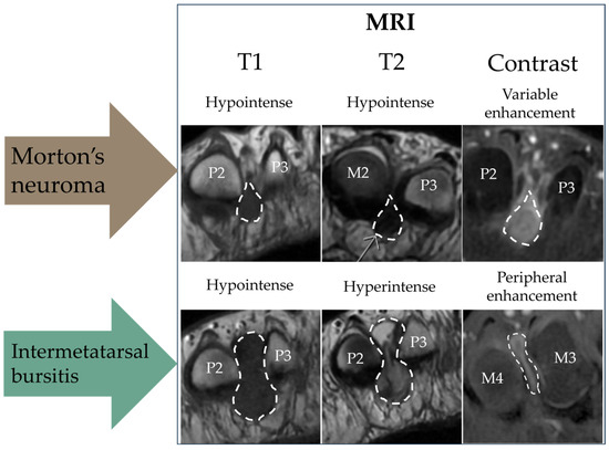 Morton’s Neuroma or Intermetatarsal Bursitis—A Prospective Diagnostic ...