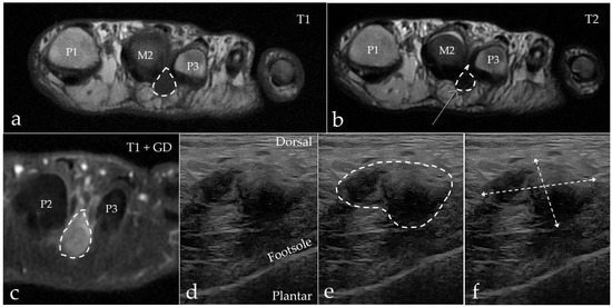 Morton’s Neuroma or Intermetatarsal Bursitis—A Prospective Diagnostic ...