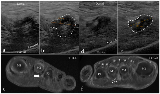 Morton’s Neuroma or Intermetatarsal Bursitis—A Prospective Diagnostic ...