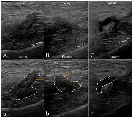 Morton’s Neuroma or Intermetatarsal Bursitis—A Prospective Diagnostic ...
