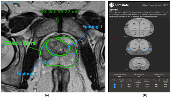 A Narrative Review of Artificial Intelligence in MRI-Guided Prostate ...
