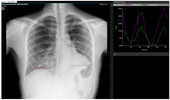 Dynamic Digital Radiography in Ehlers–Danlos Syndrome: Visualizing ...