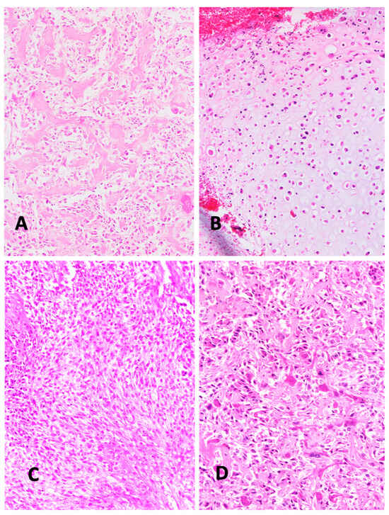 Non-Coding RNAs in Diagnostic Pathology of High-Grade Central Osteosarcoma