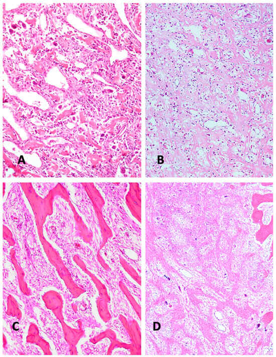 Non-Coding RNAs in Diagnostic Pathology of High-Grade Central Osteosarcoma