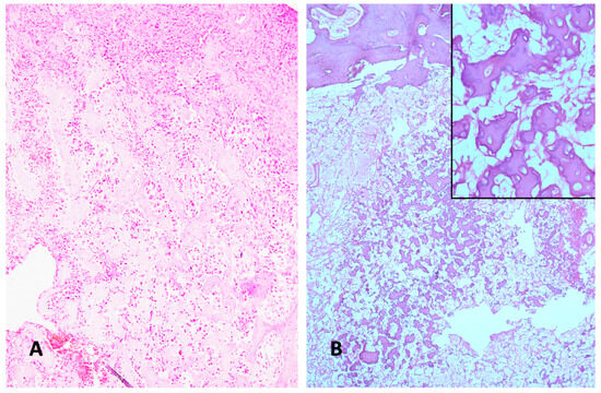 Non-Coding RNAs in Diagnostic Pathology of High-Grade Central Osteosarcoma