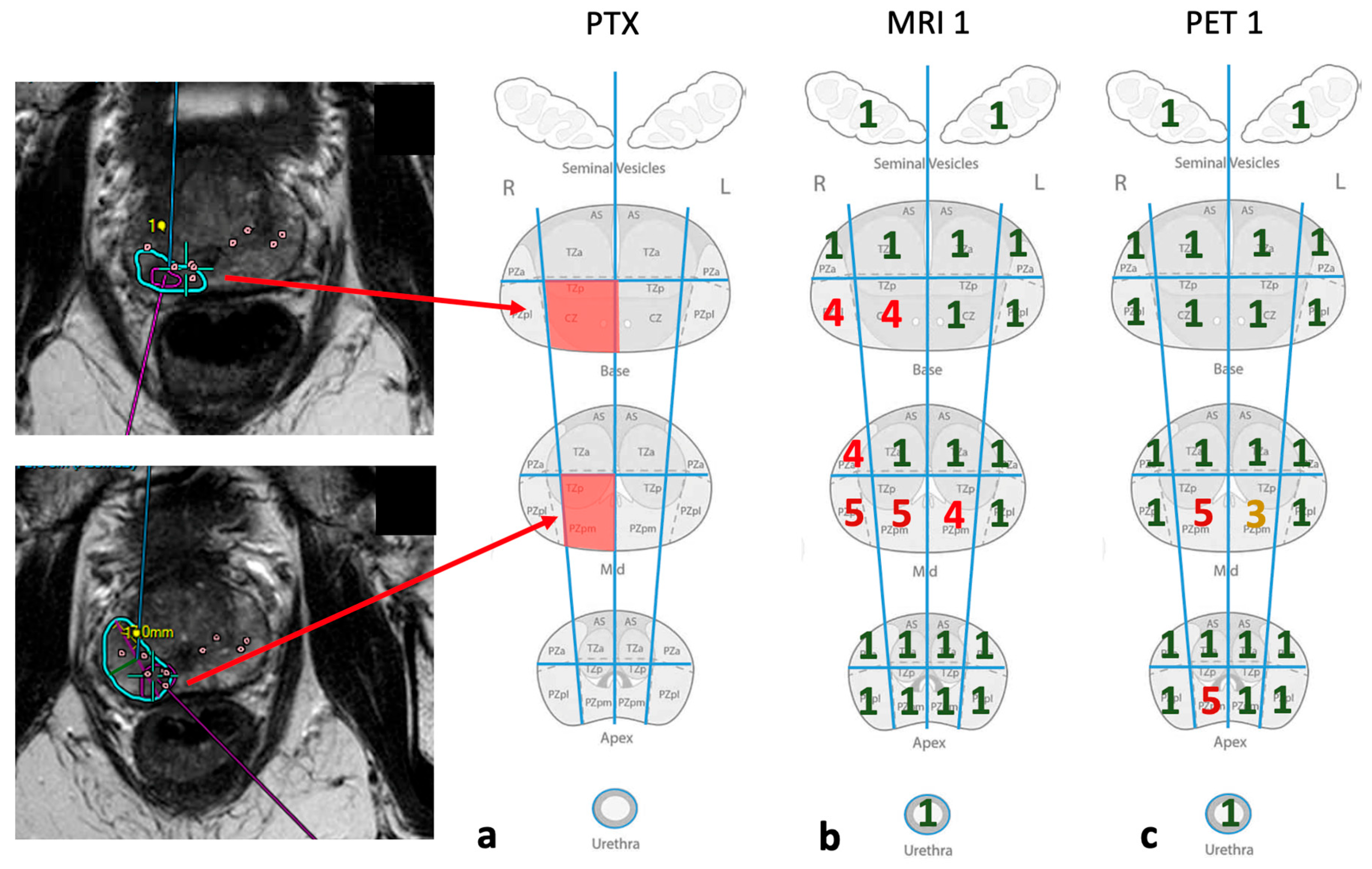 Comparison of mpMRI and 68Ga-PSMA-PET/CT in the Assessment of the ...