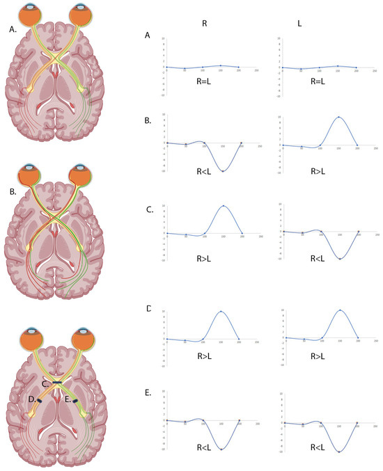 Can a Portable Flash Visual Evoked Potential (VEP) Device Identify ...