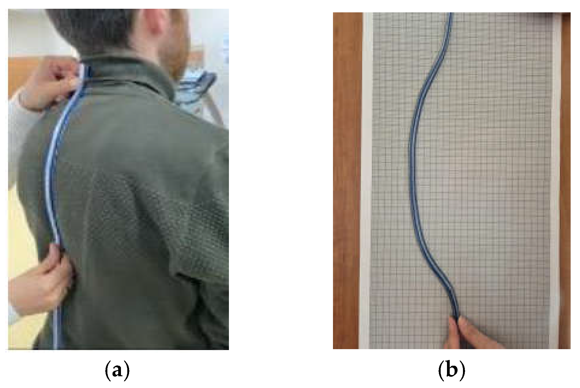 Automated Detection of the Kyphosis Angle Using a Deep Learning ...