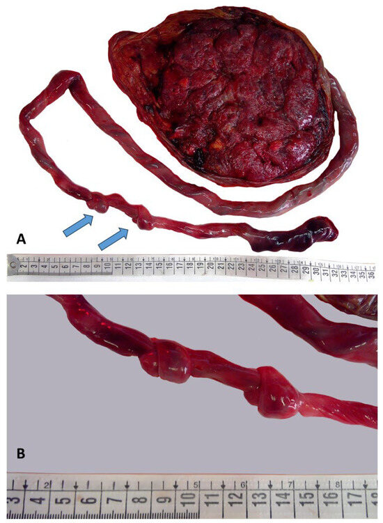 Fetal Death Due to an Unusual Coexistence of Two Umbilical Cord ...