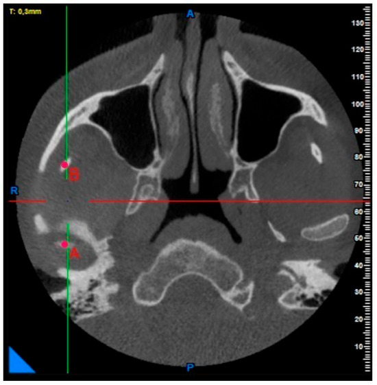 A Morphometric Evaluation of the Mandibular Condyle, Coronoid Process ...