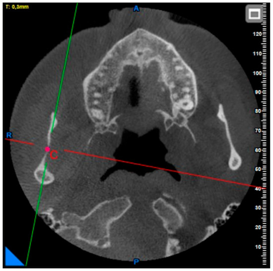 A Morphometric Evaluation of the Mandibular Condyle, Coronoid Process ...