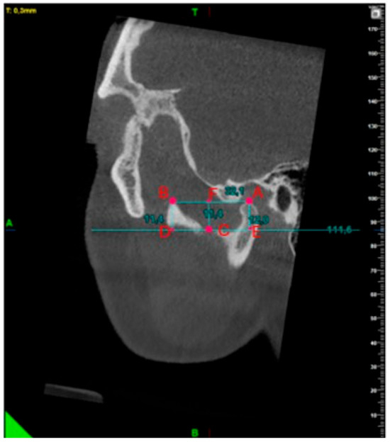 A Morphometric Evaluation of the Mandibular Condyle, Coronoid Process ...