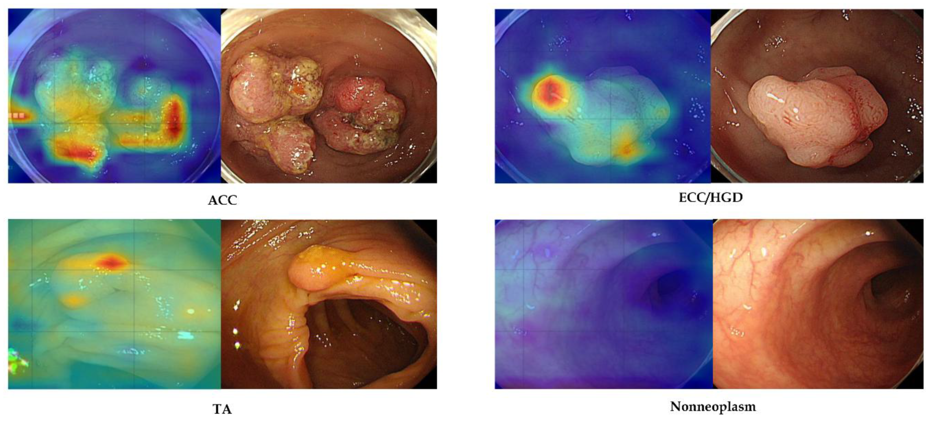 Edge Artificial Intelligence Device in Real-Time Endoscopy for the Classification of Colonic ...