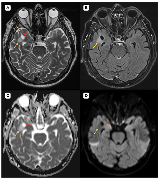 Opercular Perivascular Space Mimicking a Space-Occupying Brain Lesion ...