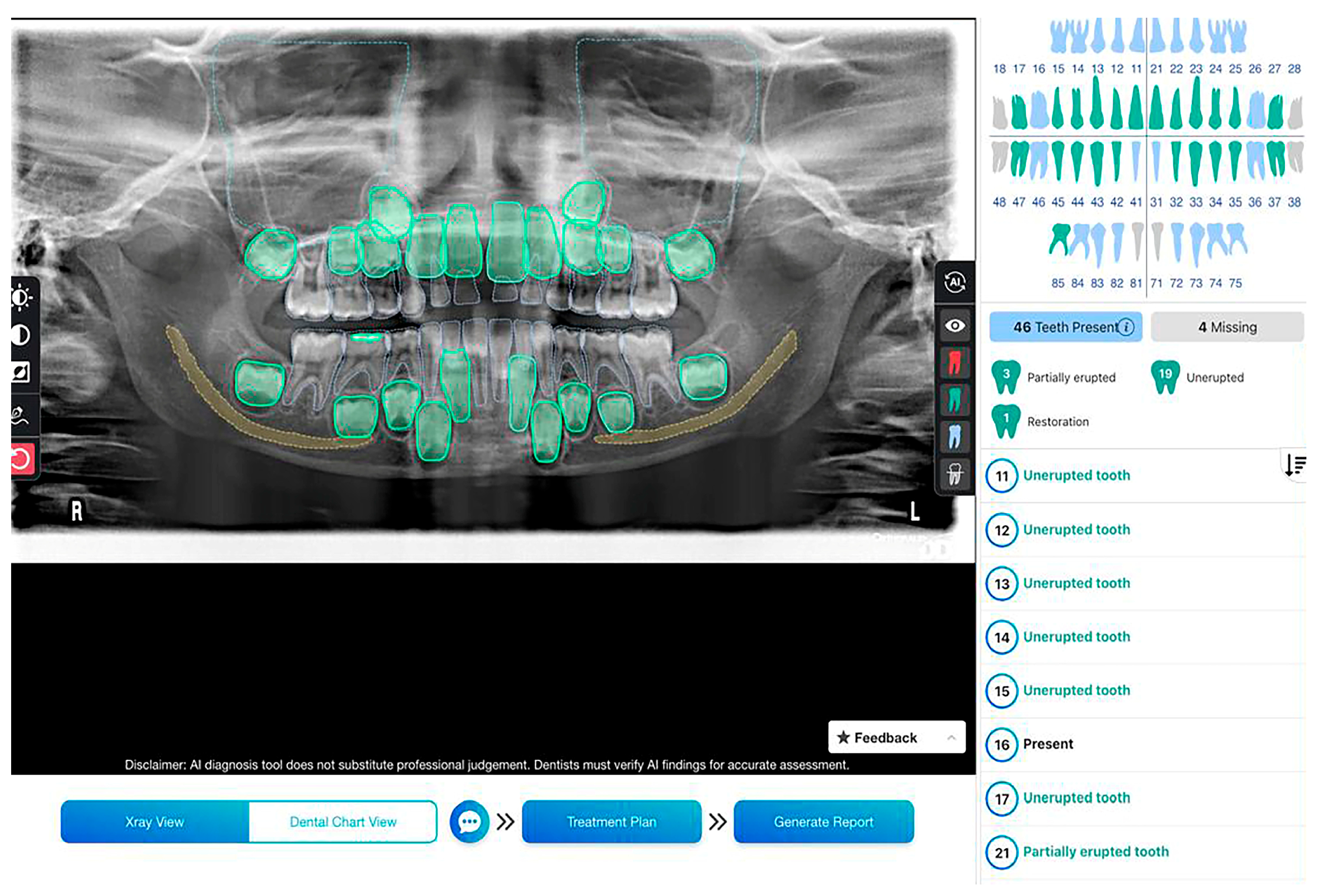 The Validation of an Artificial Intelligence-Based Software for the Detection and Numbering of ...