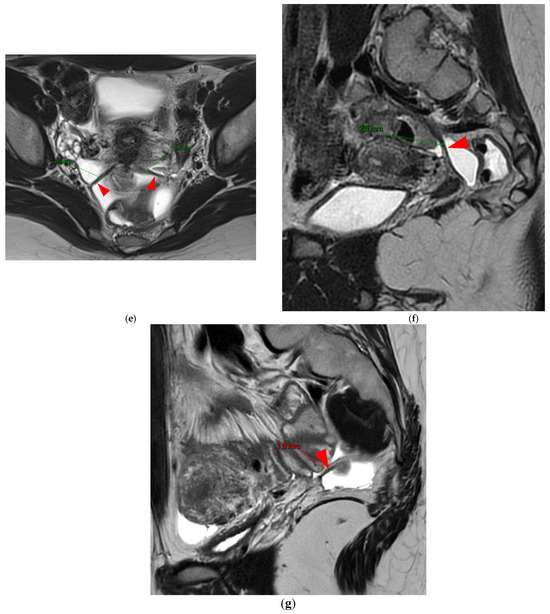 The Hôtel-Dieu MRI Classification of Uterosacral Ligament Involvement ...