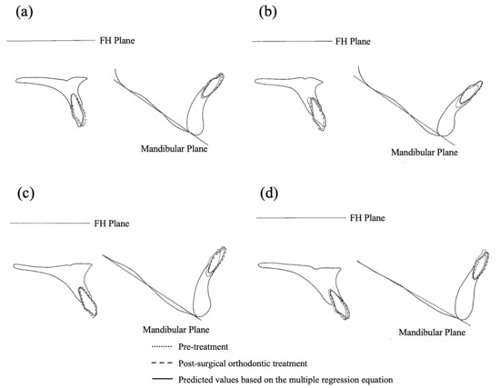 Anterior Tooth Inclination Between Skeletal Class II and III ...