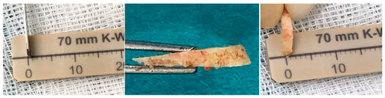 Analysis of Factors Influencing Corrective Power of Akin’s Osteotomy in ...