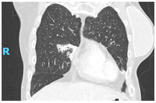 A Rare Case of Exophiala Dermatitidis Isolation in a Patient with Non ...