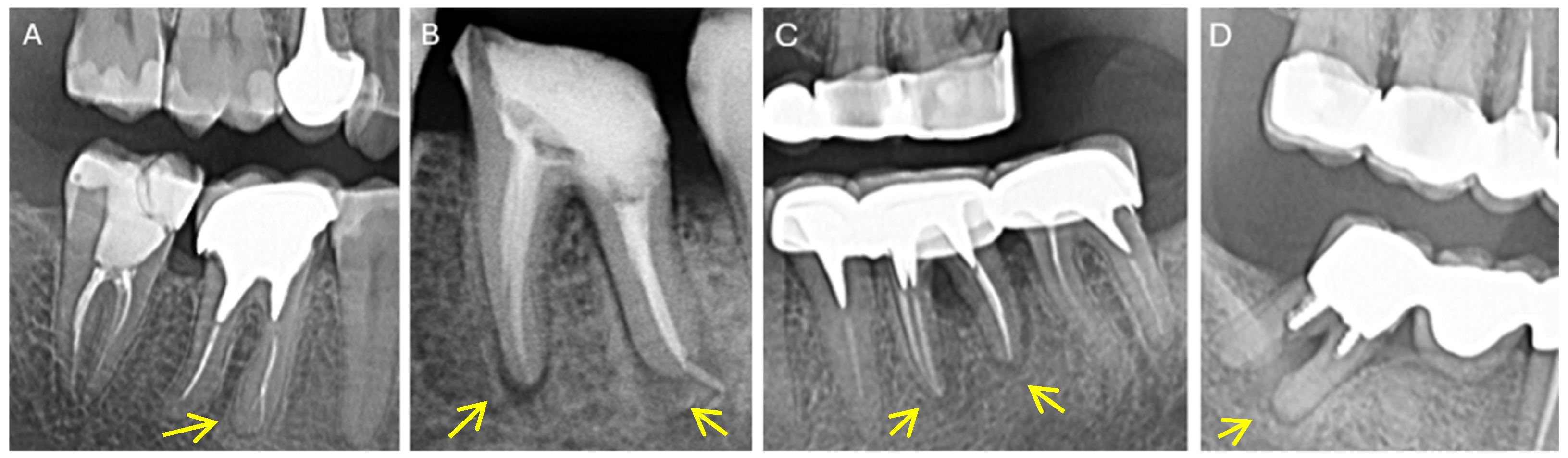 Endo-Periodontal Lesions in Endodontically Treated Teeth with ...