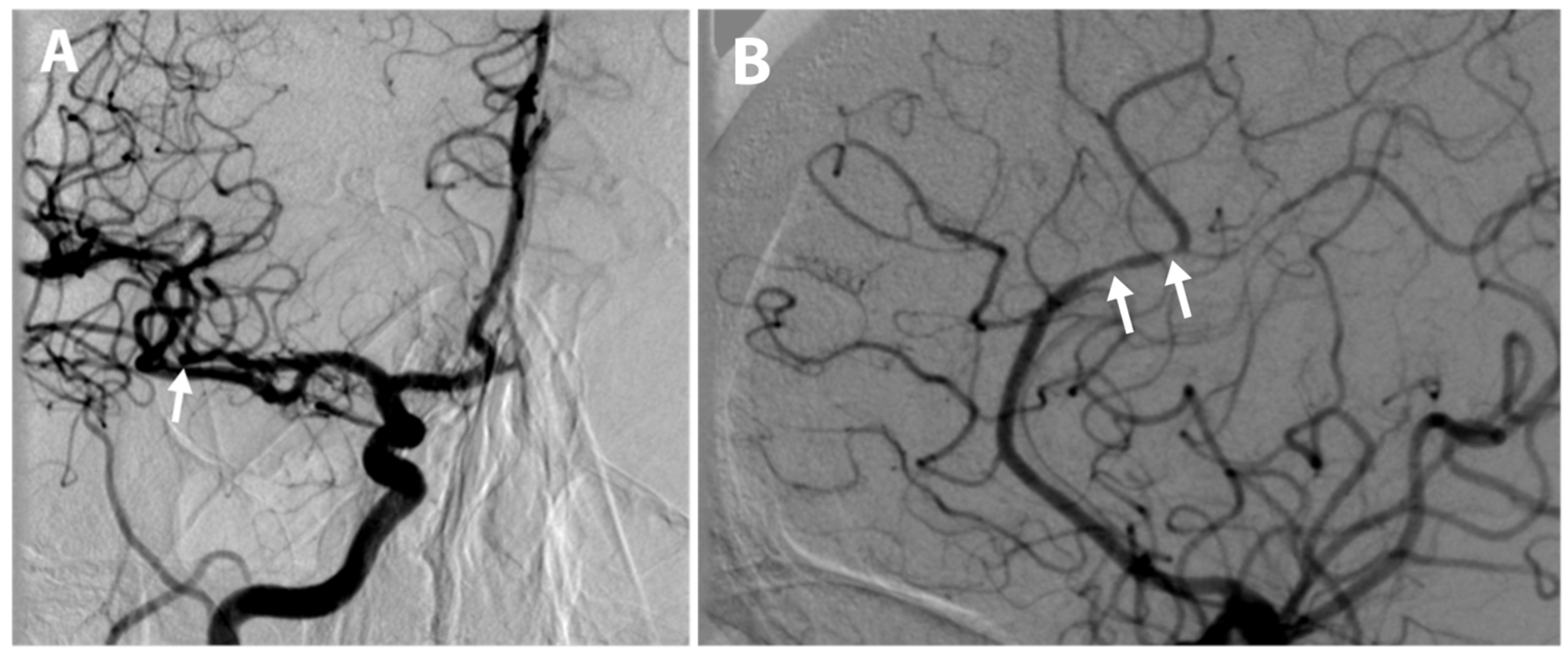 Ischemic Stroke Secondary to Arterial Tunica Media Embolism Following ...