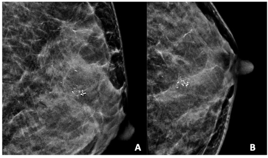 Association Between Microcalcification Patterns in Mammography and ...